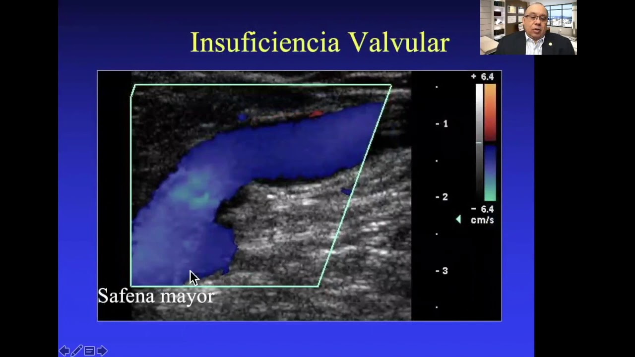 Tips de Doppler Venoso en miembros inferiores | Dr. Leandro Fernández