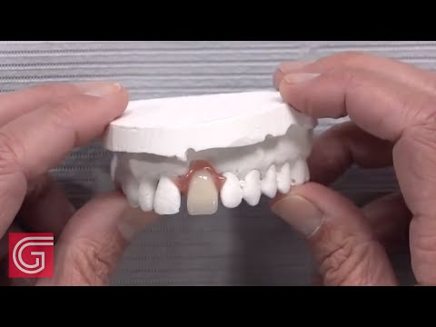 How to Avoid a Facial Metal Clasp with Reflex™ Plus Flipper