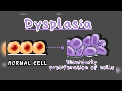 dysplasia – a disorderly but non-cancerous proliferation of cells