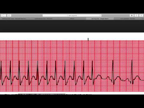 Paroxysmal supraventricular tachycardia (PSVT)