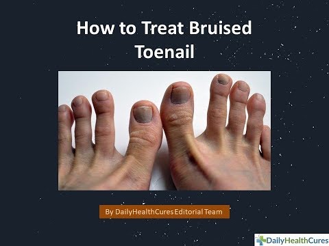 How to treat Bruised Toenail