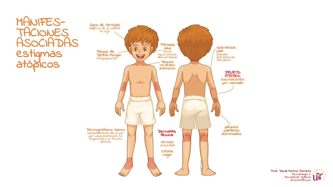 Tema 5. Dermatitis Atópica
