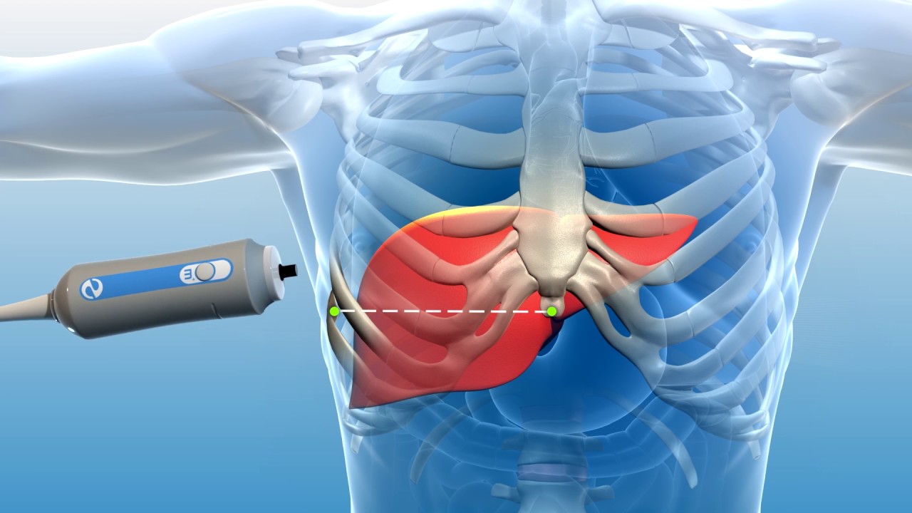 A Patient's Introduction to FibroScan