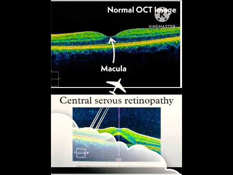 Normal oct vs Abnormal oct retina #shortvideo #viral #knowledgewithani