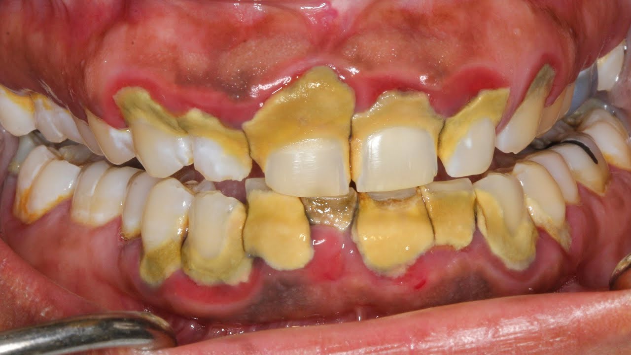15 Years Without Brushing Teeth | Calculus Buildup