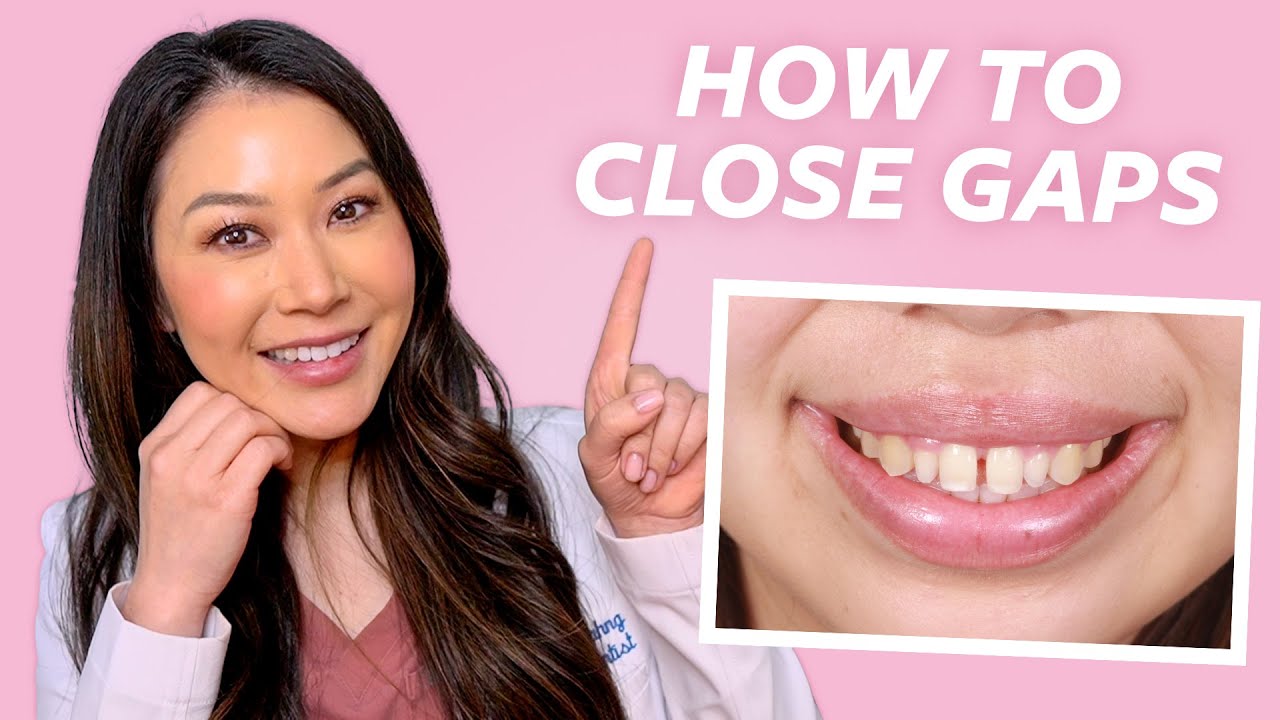 How to Close Gaps in Teeth | Cosmetic Dentist Explains