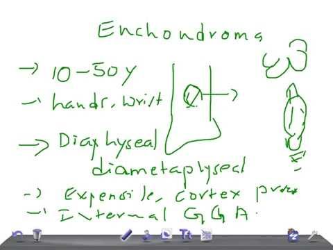 QUICK RADIOLOGY: Radiologic signs of ENCHONDROMA