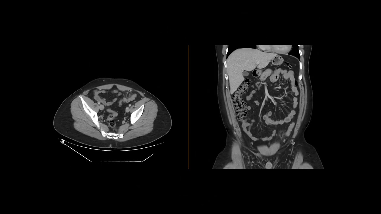 Epiploic Appendagitis