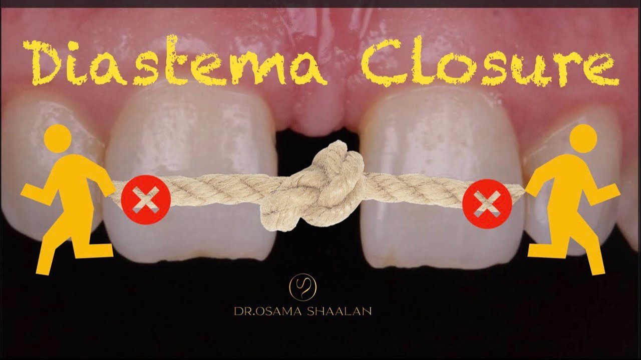 Diastema closure using direct bonding ( front wing technique)