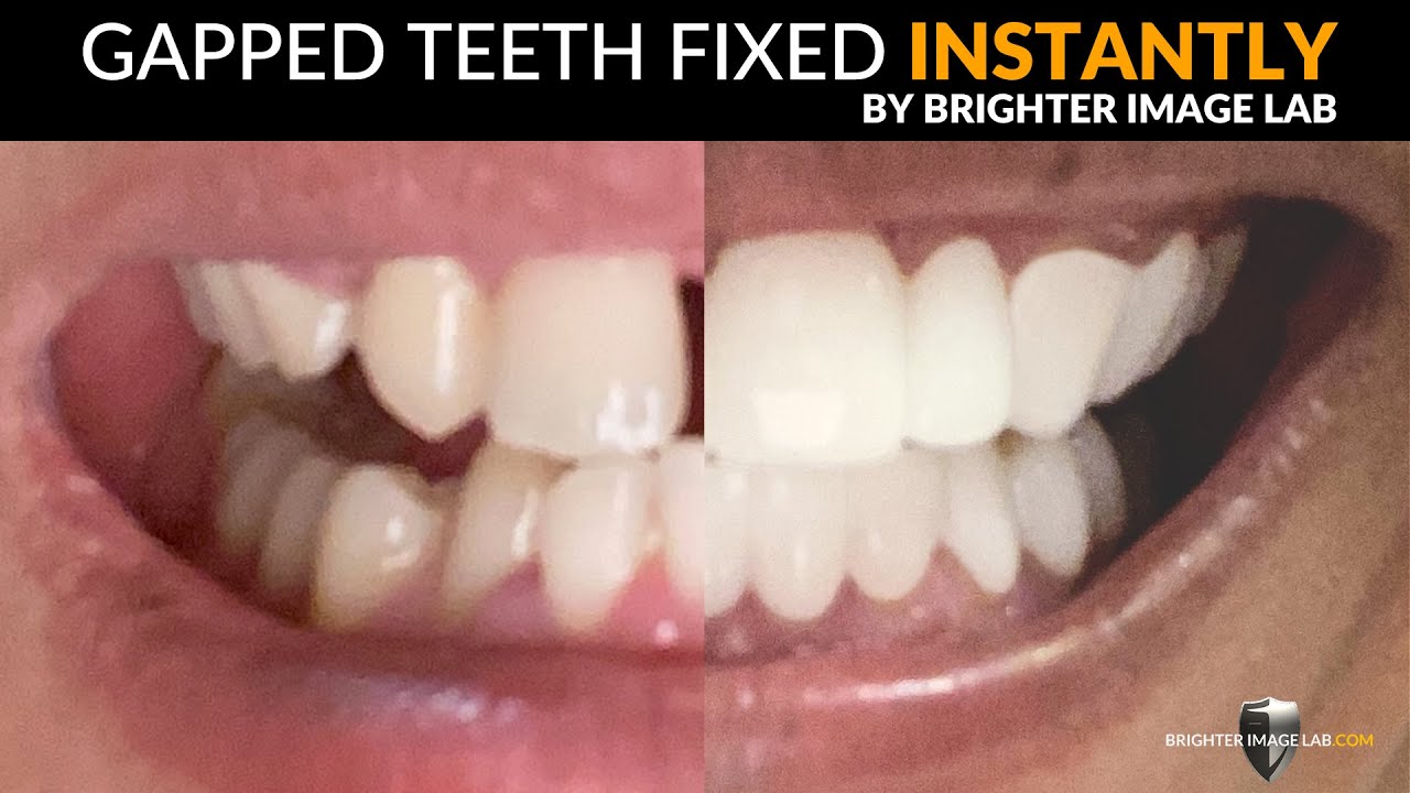 Have Gapped Teeth? Change Your Smile Instantly! - No Dentist Veneers by Brighter Image Lab