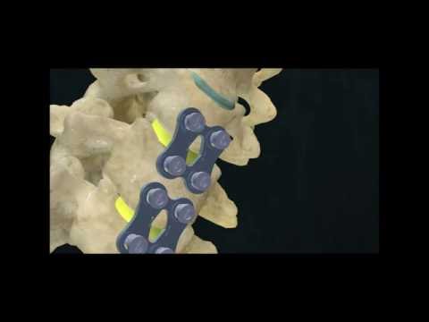 ACD PROCEDURE