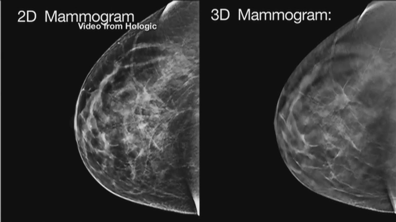 New FDA guidelines for Mammograms