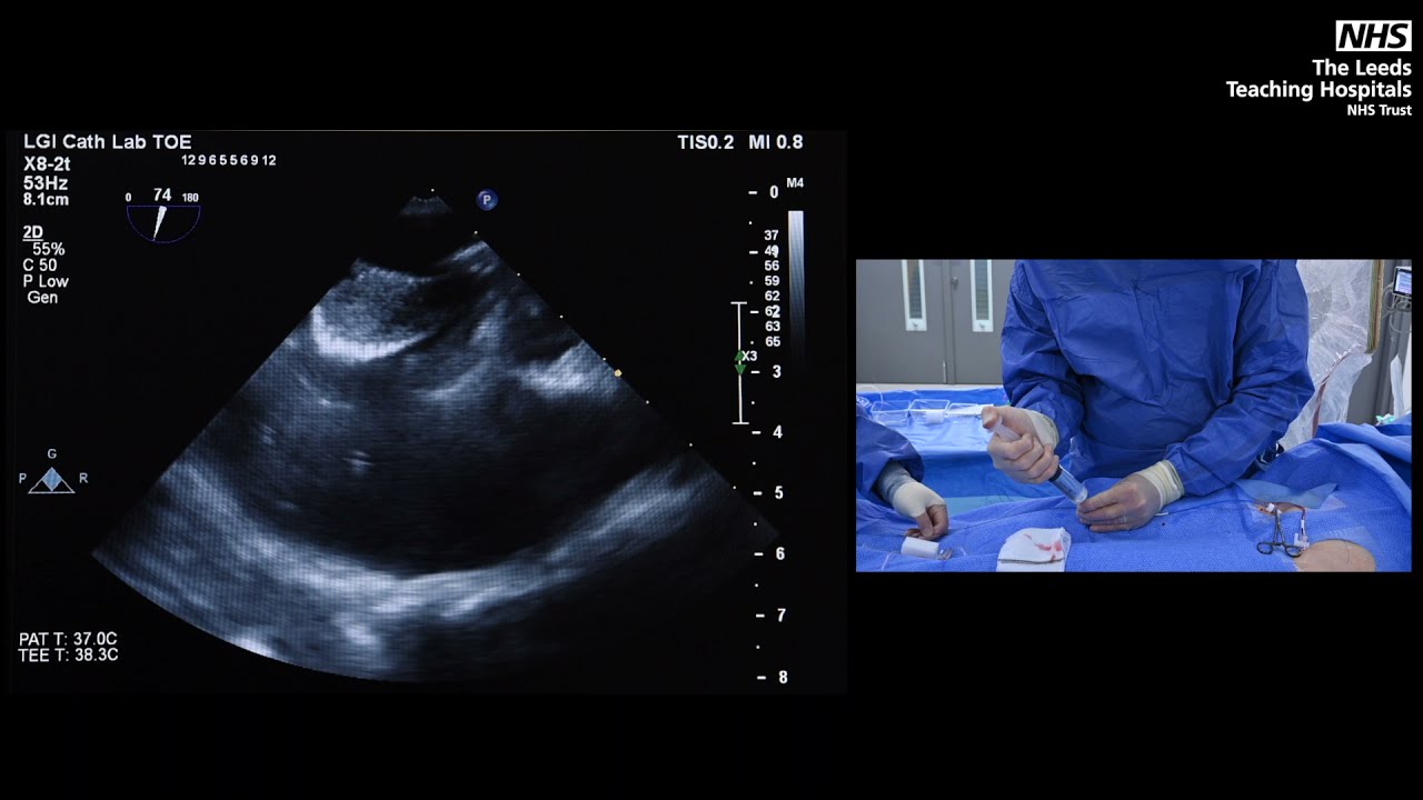 How to start using the Gore cardioform ASD occluder: Four simple cases and step by step teaching