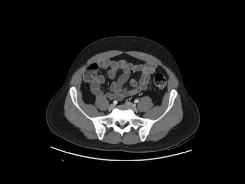 How to read a CT of the Abdomen and Pelvis - a quick, practical approach (axial)