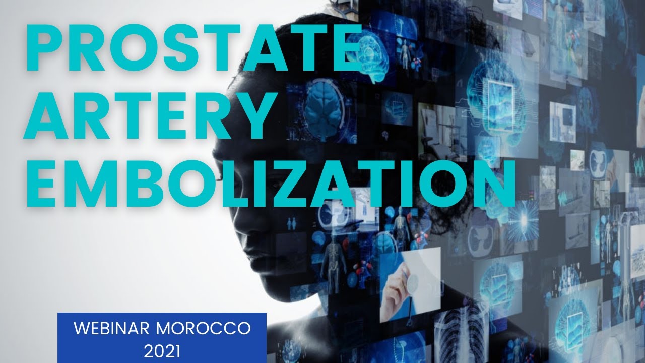 Prostatic Artery Embolization  Webinar  Basics, Techniques, Indication
