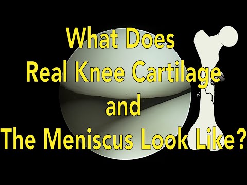 What Does Real Knee Cartilage and the Meniscus Look Like?