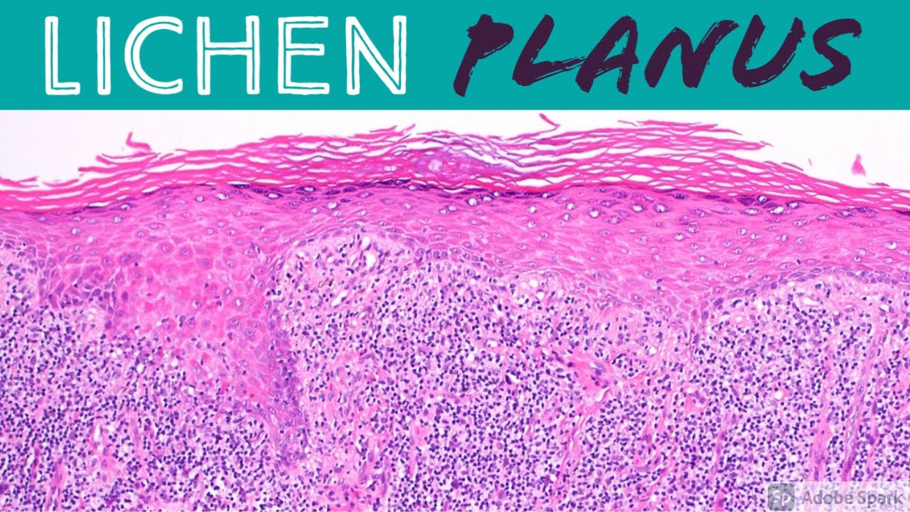 Lichen Planus & Hypertrophic Lichen Planus: Inflammatory Dermpath 101 for Dermatology & Pathology