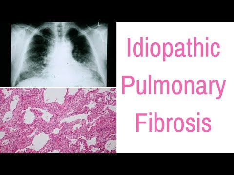 What is the Life Expectancy and Outlook for Idiopathic Pulmonary Fibrosis