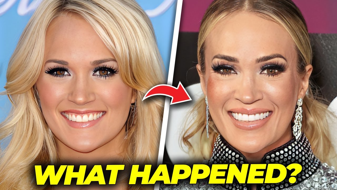 The Truth on What Happened to Carrie Underwood's Face