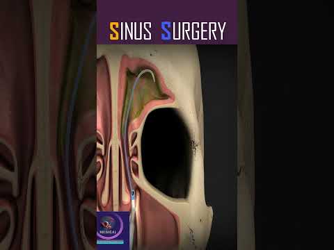 Ballon Sinuplasty, Sinus Surgery #shorts