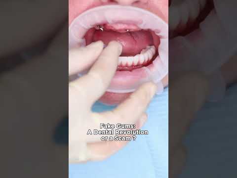 What Are Fake Gums?
