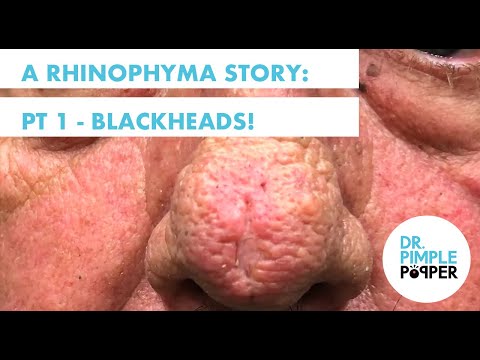 A Rhinophyma Story: Part 1 - Blackheads!