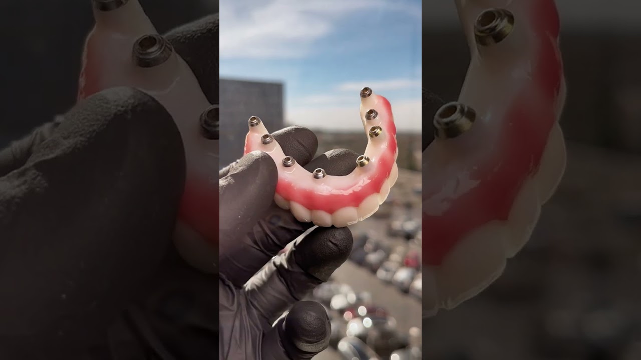 Perfecting Your Smile: A Trust Implants Zirconia Prosthesis Showcase