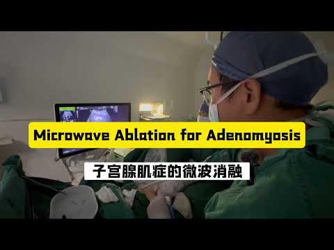 Microwave Ablation for Adenomyosis