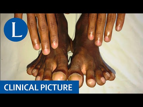 No clubbing in the fingers only in toes: severe pulmonary arterial hypertension
