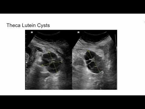 Molar Pregnancy
