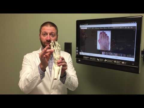 Bunion Surgery Expert