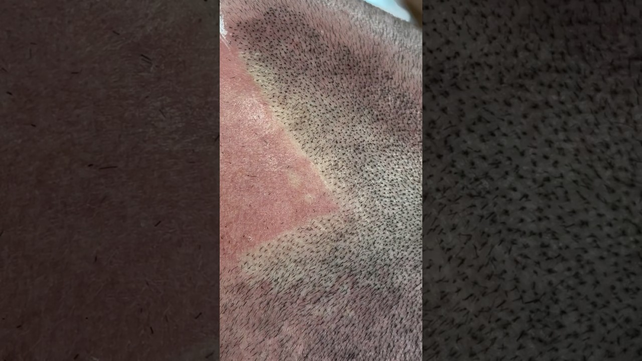 How “REAL” Can SMP look!        #scalpmicropigmentation