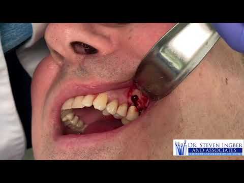 2 Of4 Understanding And Treatment Rationale For Asymptomatic Apicoectomy And Bone Grafting