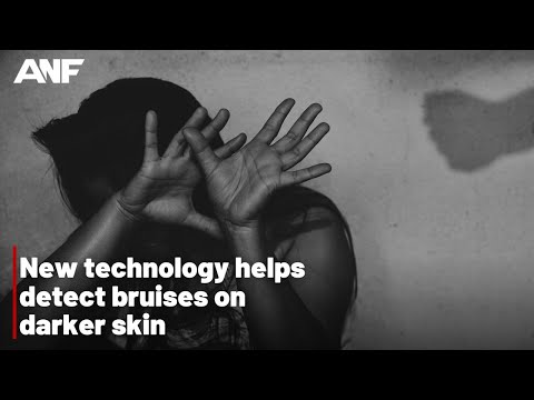 New technology helps detect bruises on darker skin