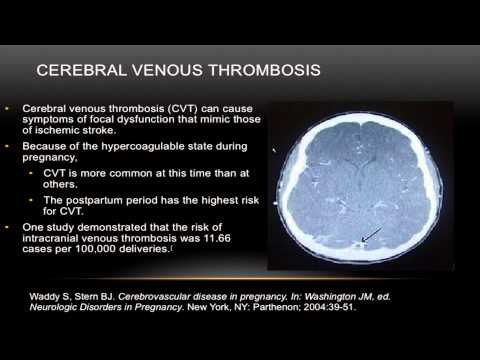 Treatment of Stroke in Pregnancy, by Francisco Esparza, MD