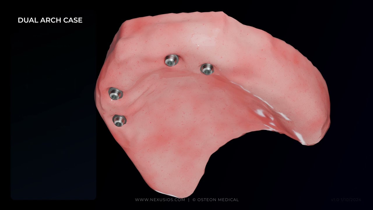 Nexus iOS - Definitive Protocol Screw Retained - Dual Arches