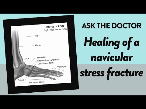Ask the Doctor: Healing of a navicular stress fracture