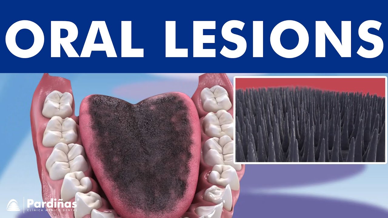 Lichen planus, leukoplakia, geographic tongue, and other oral mucosal lesions ©