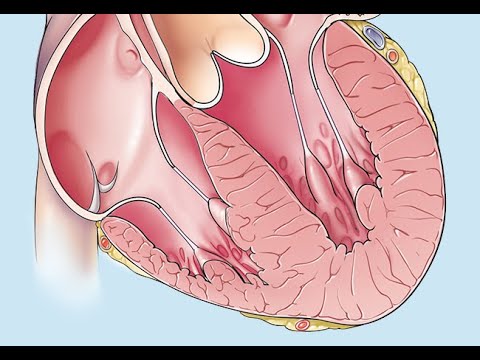 VALOR-HCM Shows Promise for Patients With Hypertrophic Cardiomyopathy (for Healthcare Professionals)