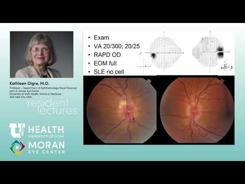 Papilledema - IIH, Non-IIH, Approach to ON Edema