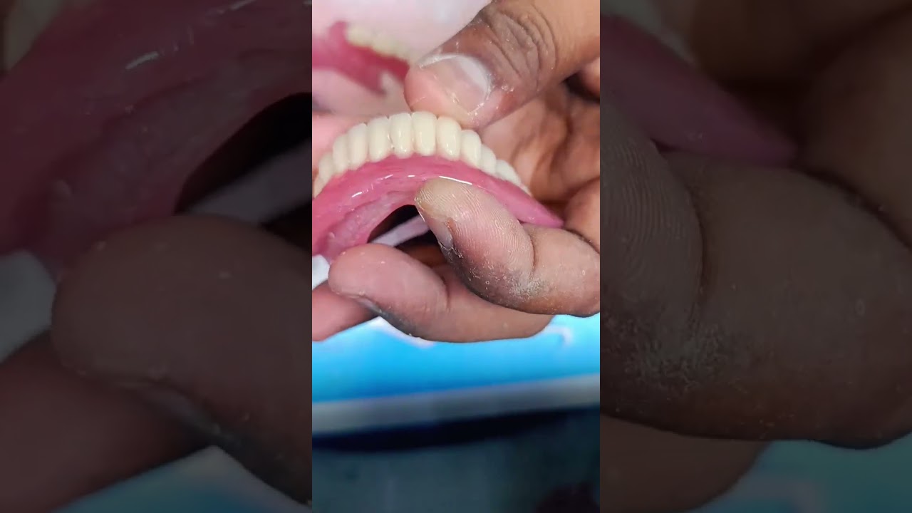 complete denture