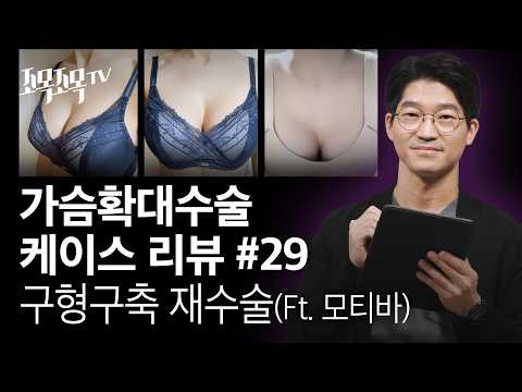 가슴확대수술 케이스 29 - 구형구축 재수술 모티바