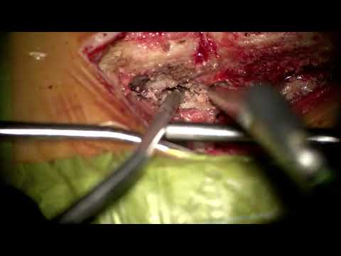 Lumbar spinal stenosis / Bilateral laminectomy and facetectomy with unilateral approach.