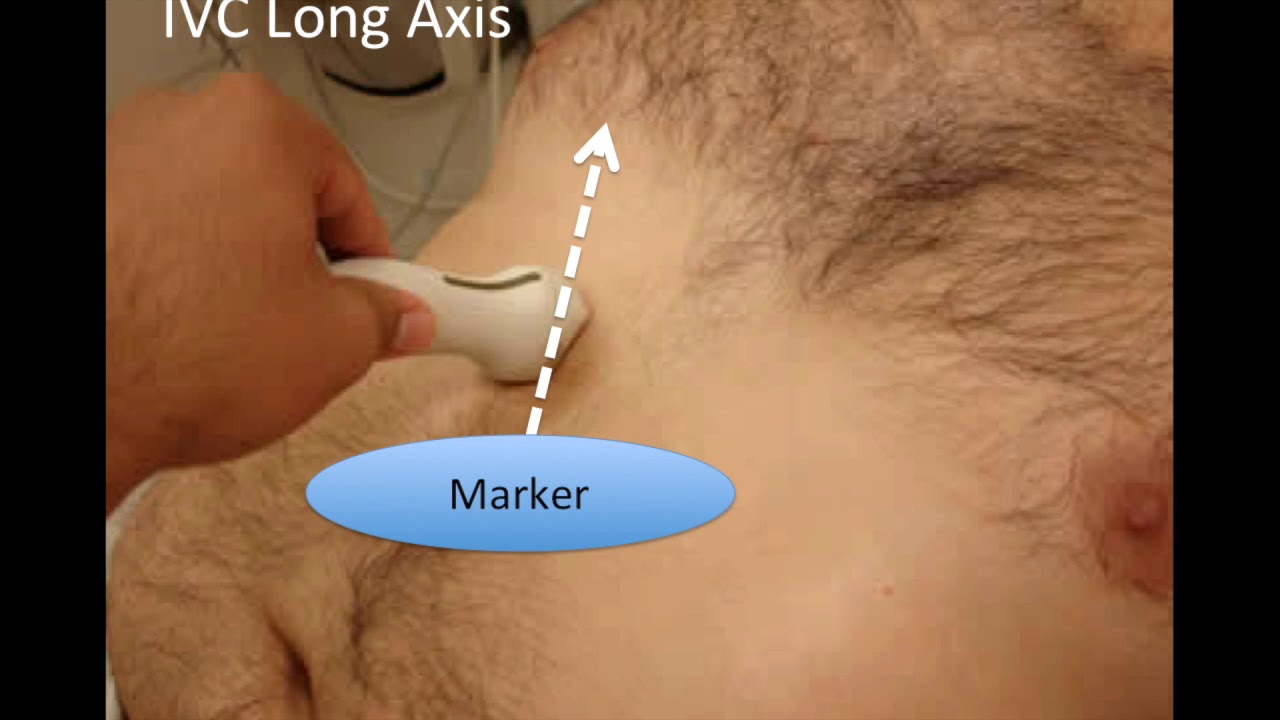 RUSH Protocol - Rapid Ultrasound for Shock and Hypotension