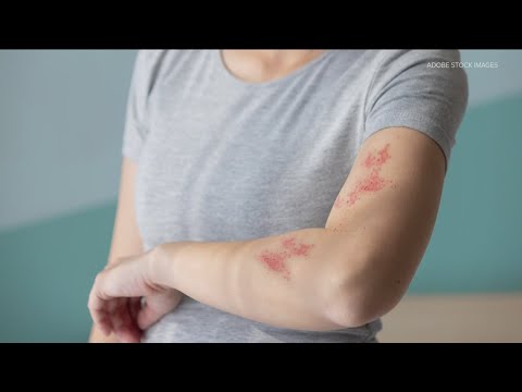 New molecule could treat virus that causes shingles, chickenpox