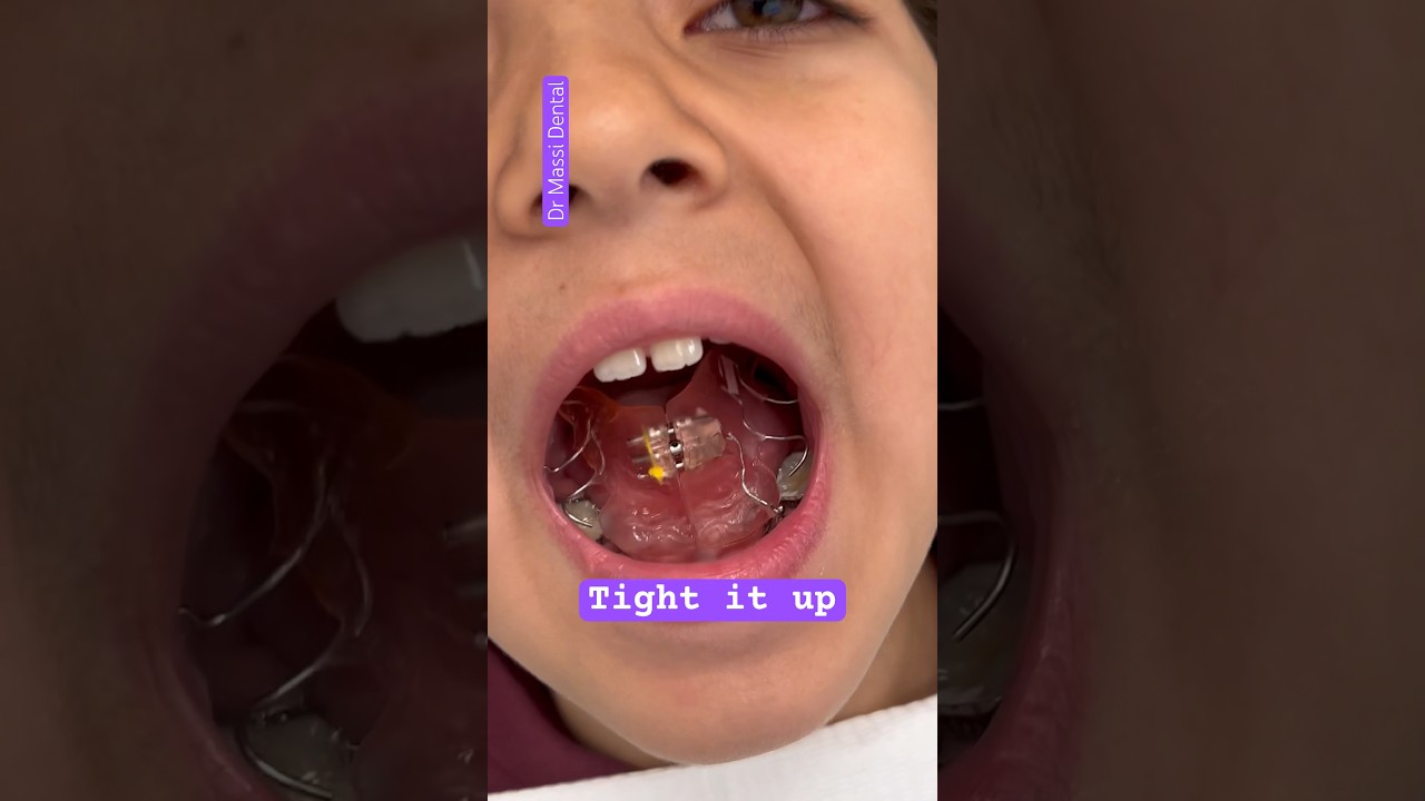 BRACES, Orthodontics, Maxillary Expansion devices