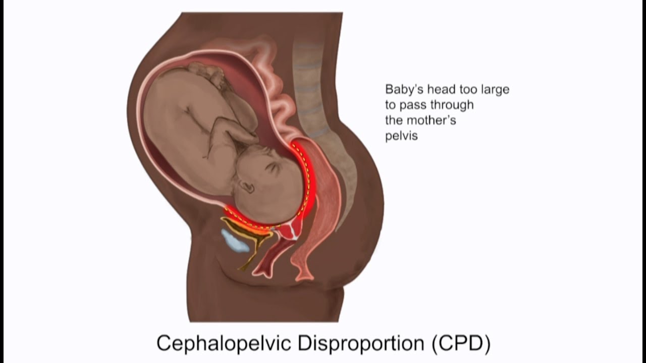 Cephalopelvic Disproportion CPD and Birth Injury
