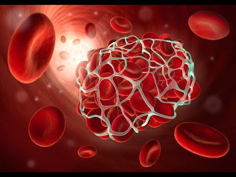 What is Pulmonary embolism? Causes, Signs and Symptoms of Blood clot in Lungs