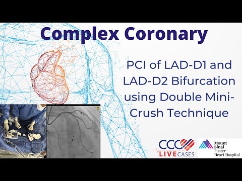 PCI of LAD-D1 and LAD-D2 Bifurcation using Double Mini-Crush Technique