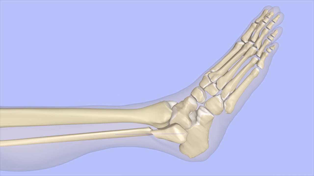 Ankle Fracture Surgery